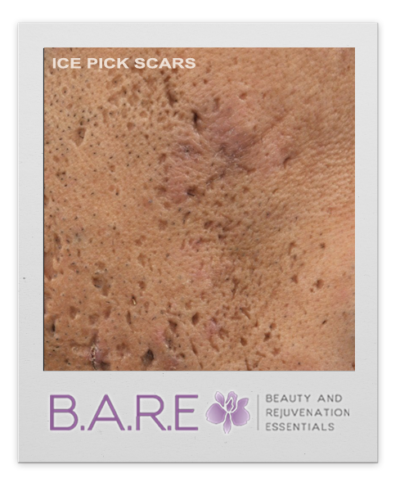 Acne Scar Laser Treatments in Windsor Ont. - B.A.R.E. Essentials Spa