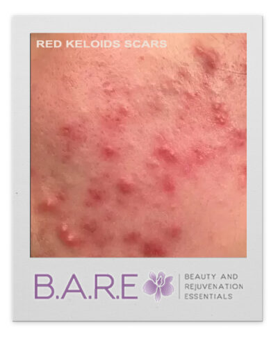 Acne Scar Laser Treatments in Windsor Ont. - B.A.R.E. Essentials Spa