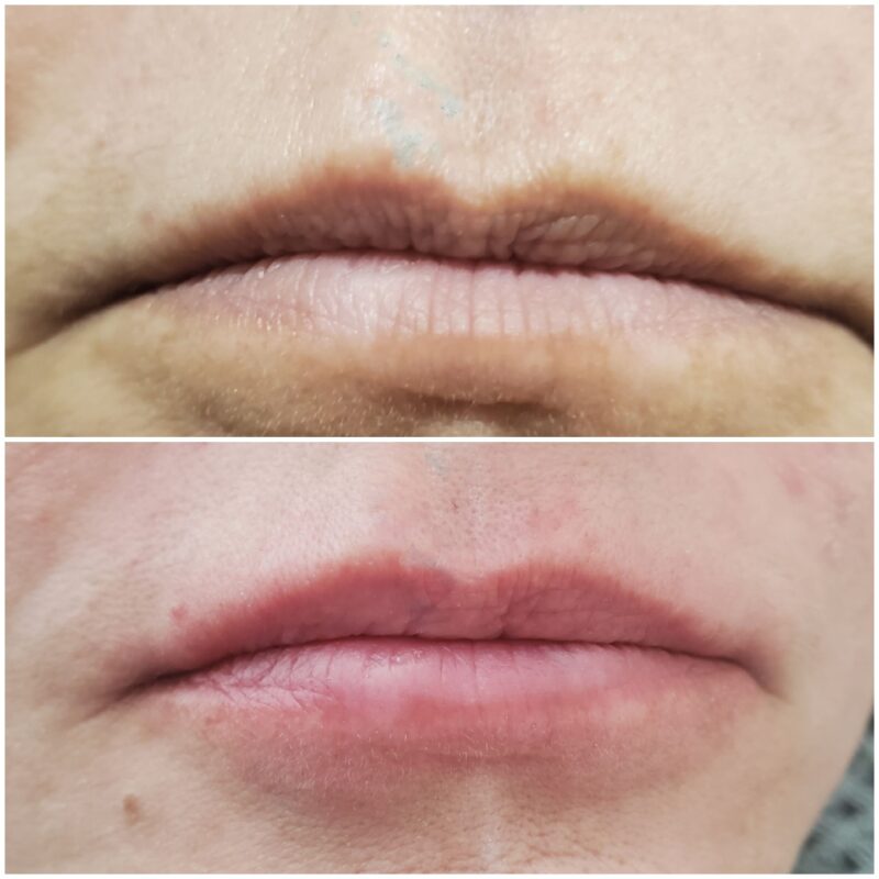 How Does LipLase Laser Treatment Work? - B.A.R.E. Essentials Spa