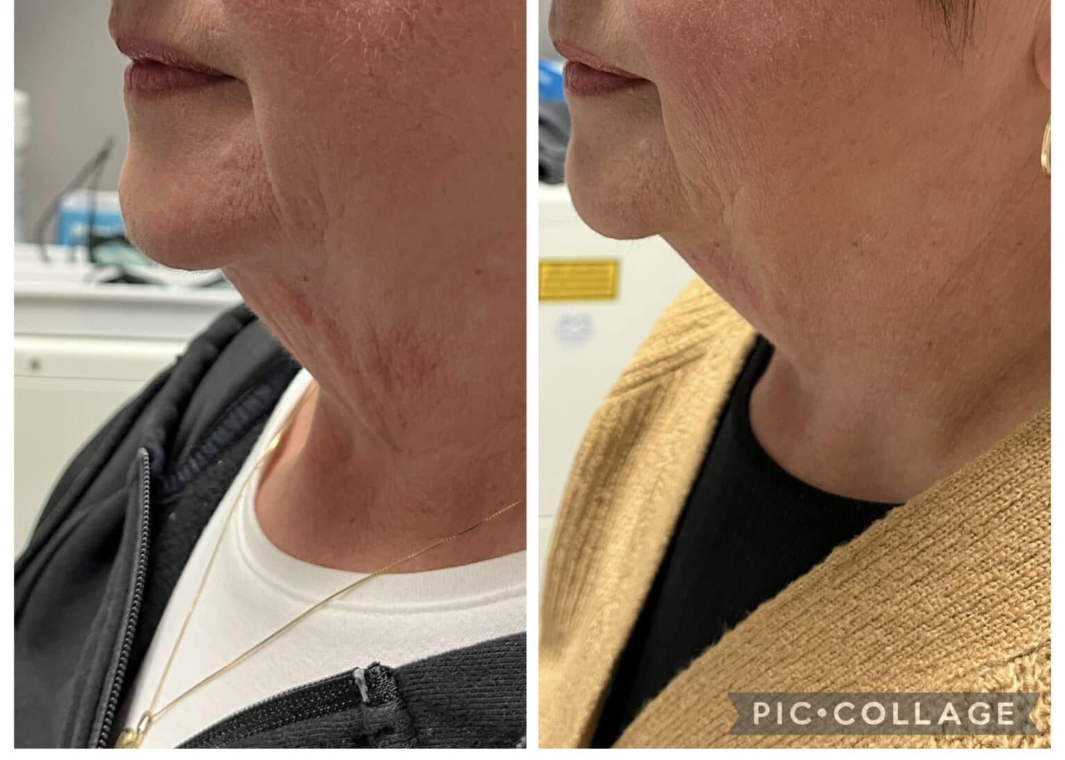 What Is Thermage Skin Tightening? - B.A.R.E. Essentials Spa