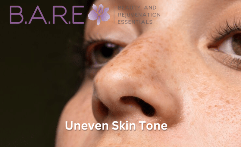 What is Uneven Skin Tone? 5 Ways to Fix It - B.A.R.E. Essentials Spa