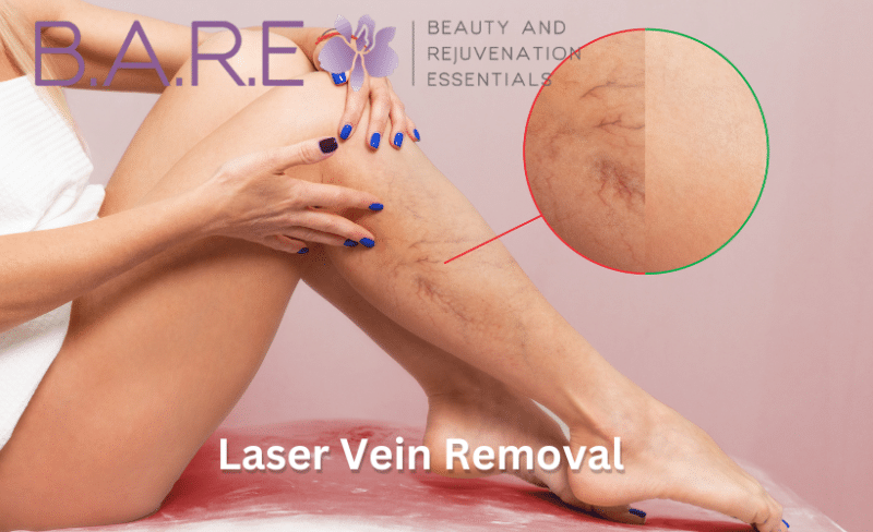 Why Choose Laser Vein Removal in Tecumseh for Leg Health - B.A.R.E. Essentials Spa